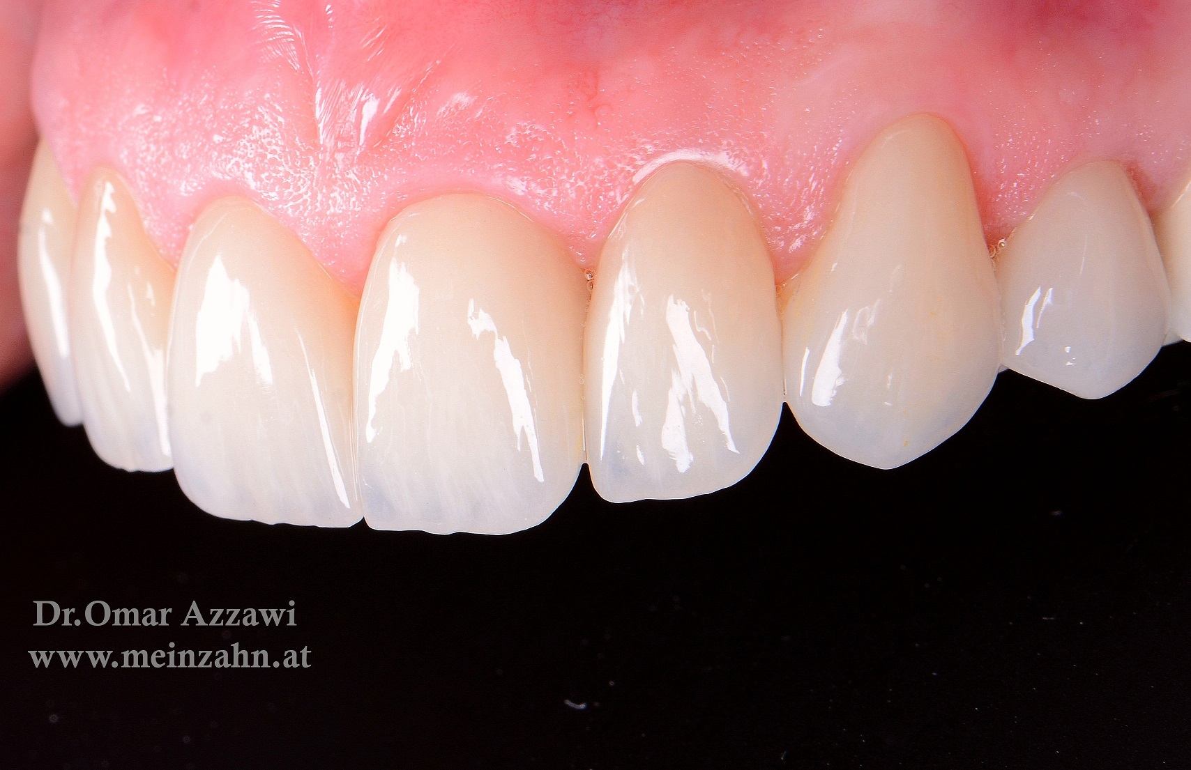 Veneers Wien - ästhetische Frontzahnkorrekturen | Zahnarzt Dr. Zsolt ...